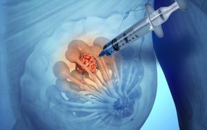 Nódulo na Mama: O que é, Causas e Diagnóstico