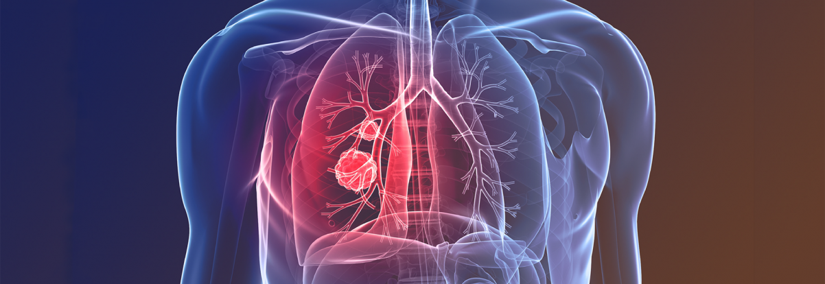 Tipos de câncer: conheça os mais comuns - IMEB